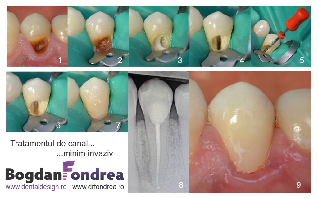 Cum se realizeaza un tratament de canal? - Dr. Bogdan Fondrea