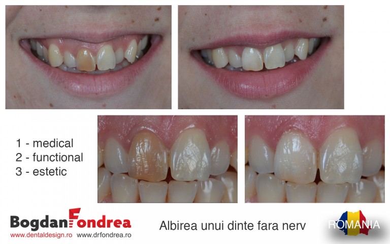 Albirea unui dinte fara nerv - Dr. Bogdan Fondrea