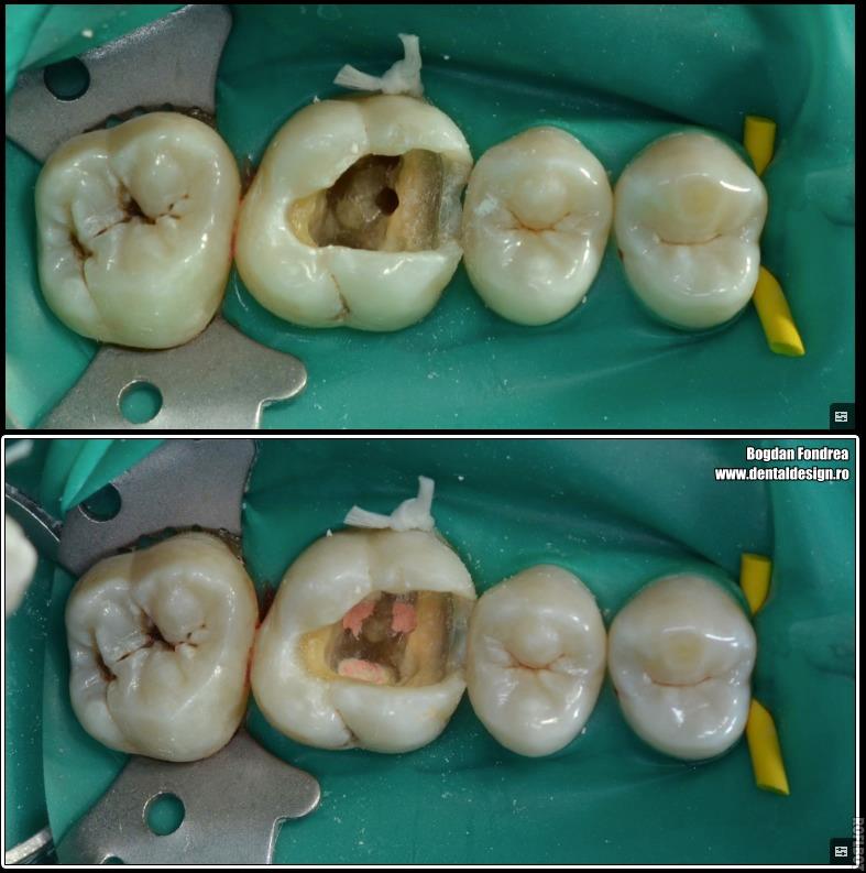 plomba - Dr. Bogdan Fondrea