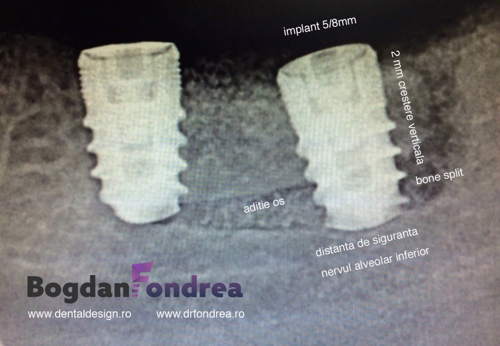 Bone split, implanturi dentare in os subtire - Dr. Bogdan Fondrea
