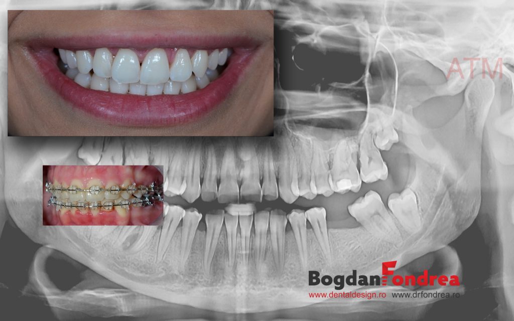 Articulatia temporo-mandibulara - Dr. Bogdan Fondrea